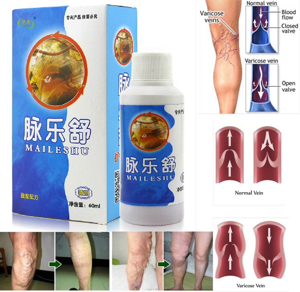 Buy vasculitis and Vein Cream to Conceal and Erase Varicose / Spider ...